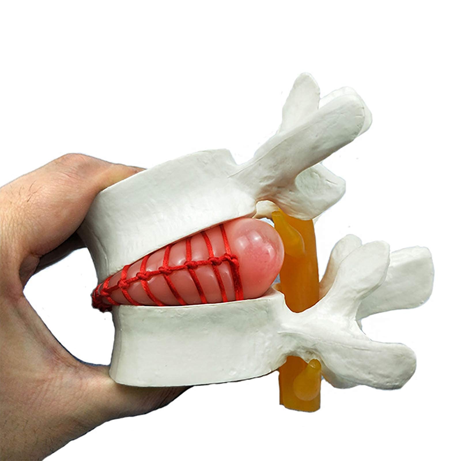 Human Spine Model Lumbar Disc Herniation Demonstration Model Spine ...