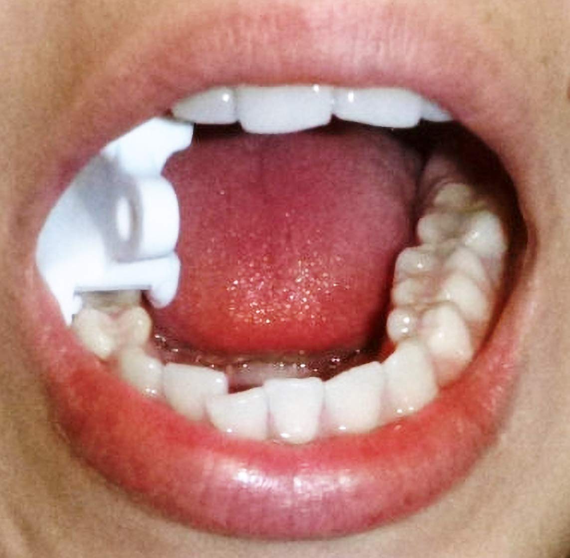 Tonsillectomy Scabs Day 5