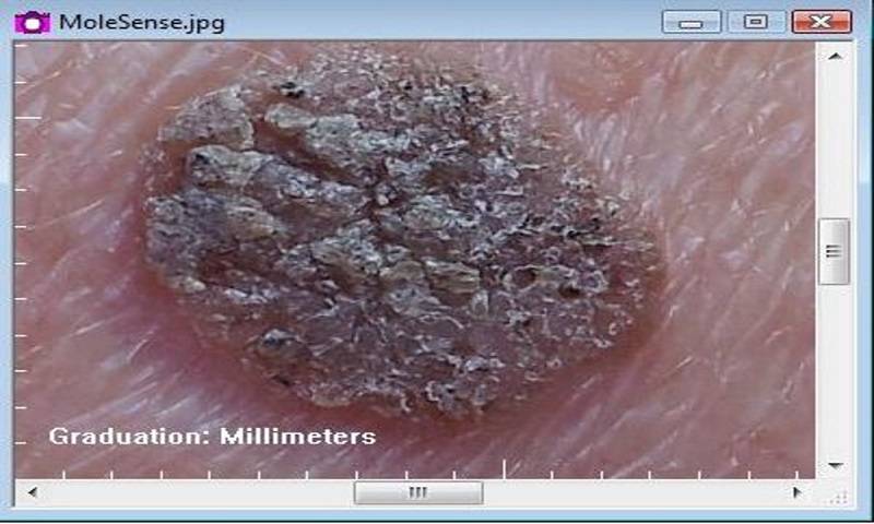 Skin Mole Analysis - App on the Amazon Appstore