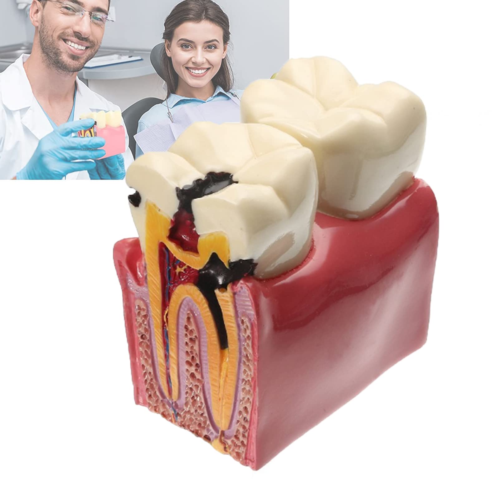 Dental Caries Teeth Model 6 Times Cross Section Demonstration Model ...
