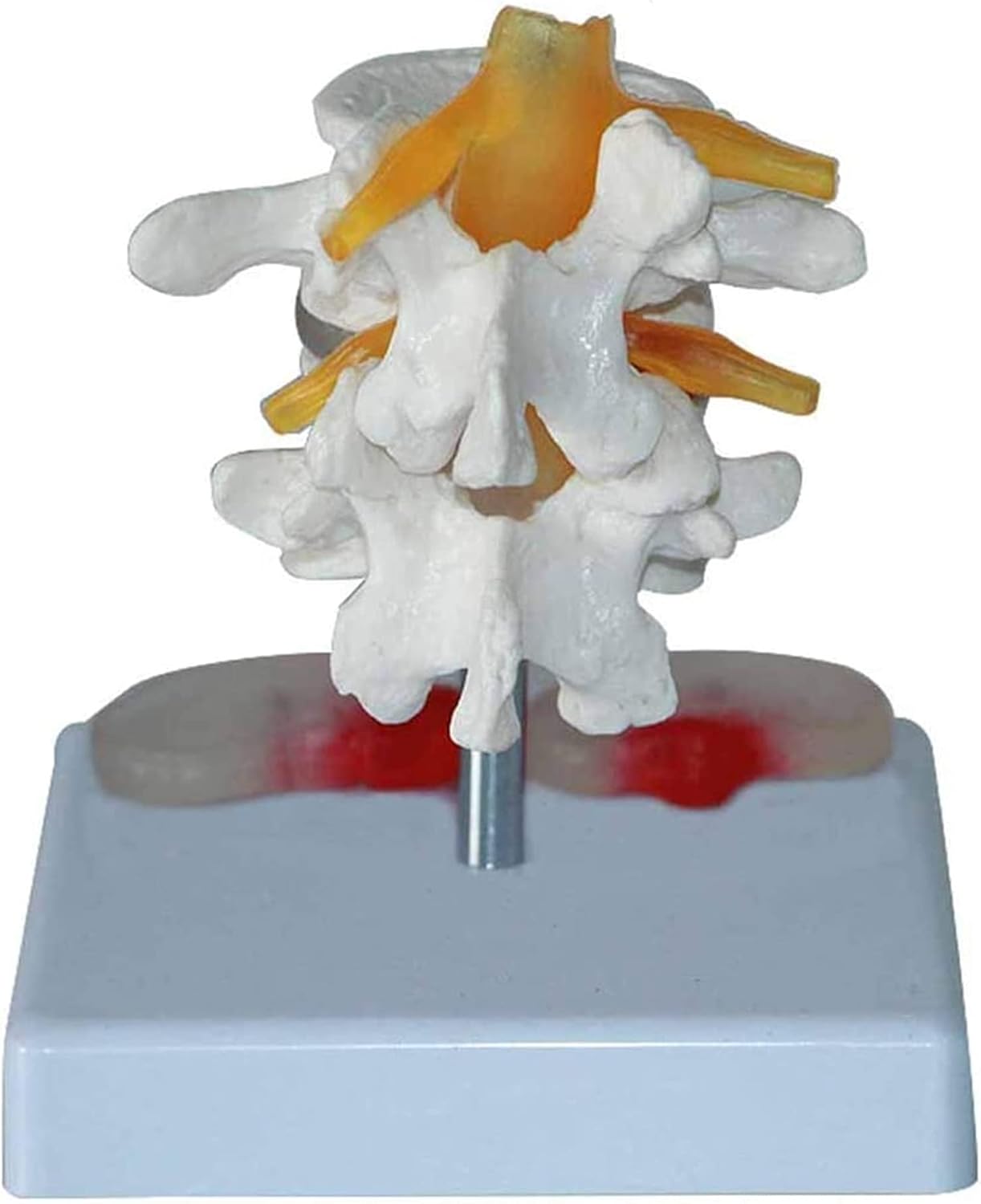 Educational Model, Lumbar Anatomy Model and Diseased Intervertebral ...
