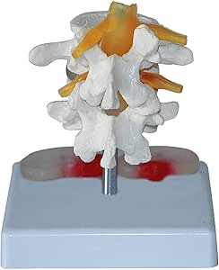 Amazon.com: Lumbar Anatomy Model and Diseased Intervertebral Disc Model ...