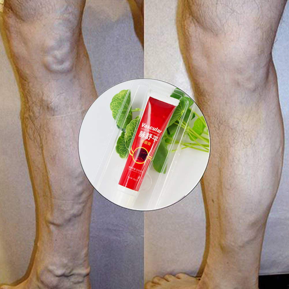 Herbal Ointment Varicose Veins Vasculitis Treatment Phlebitis Angiitis ...