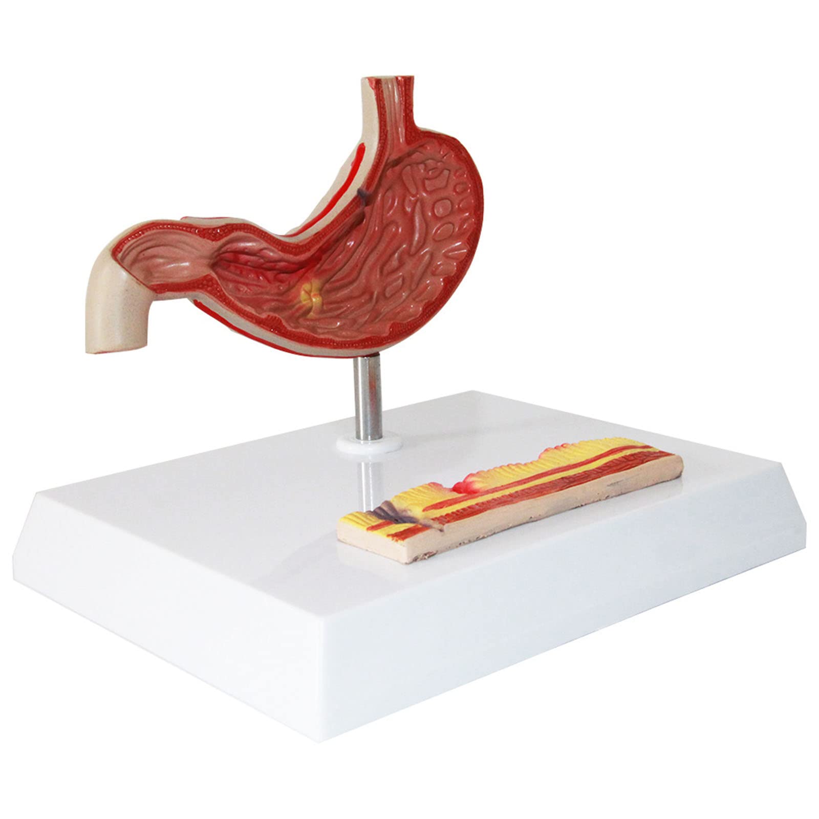 Gastric Ulcer Anatomy Model Stomach Disease Demonstration Model Human ...