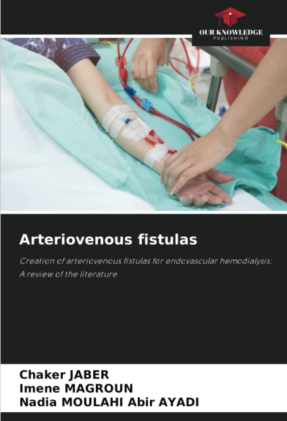 Arteriovenous Fistulas Creation Of Arteriovenous Fistulas For ...