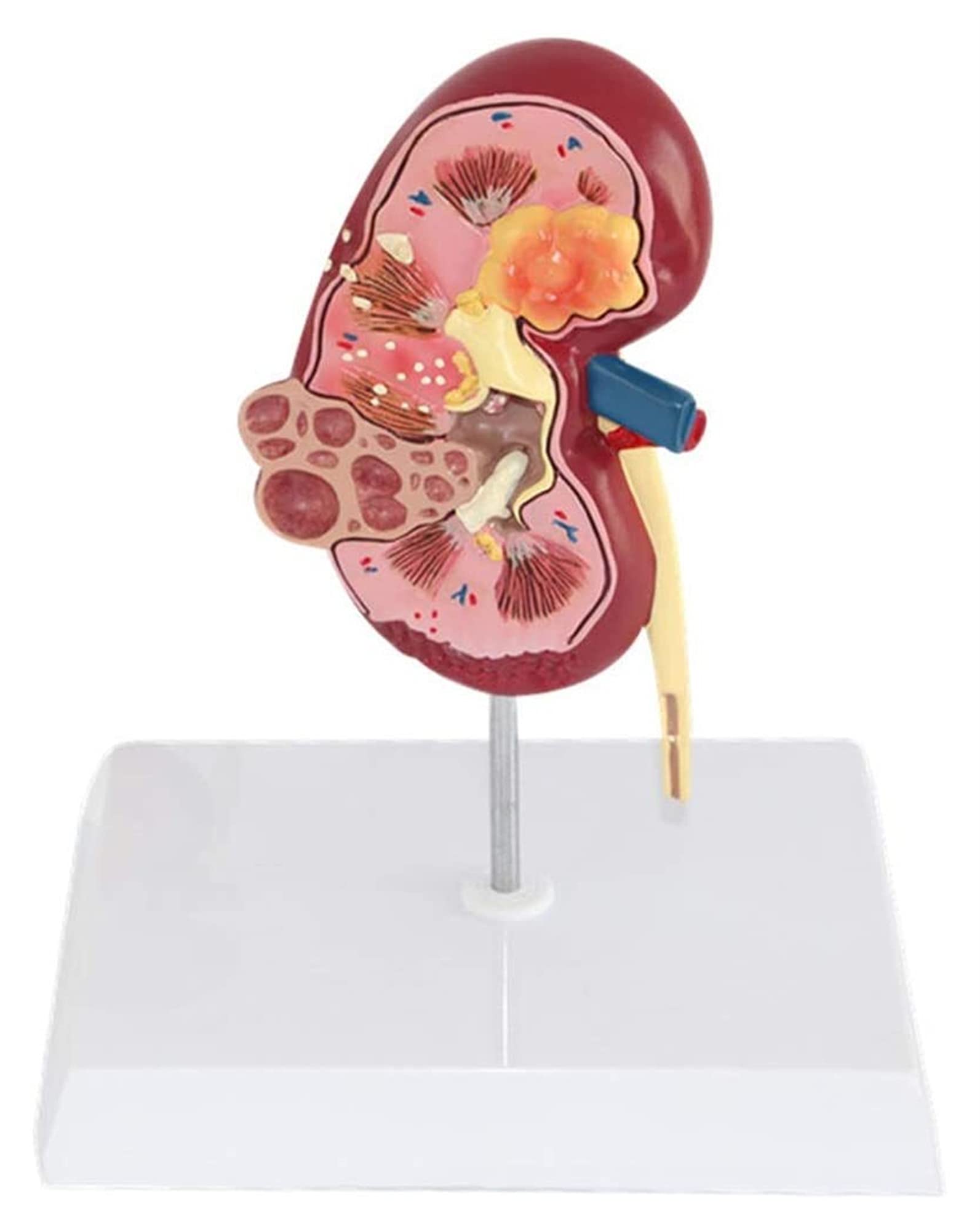Buy LAErper Teaching Model, Human Kidney Disease Model - Renal Model ...