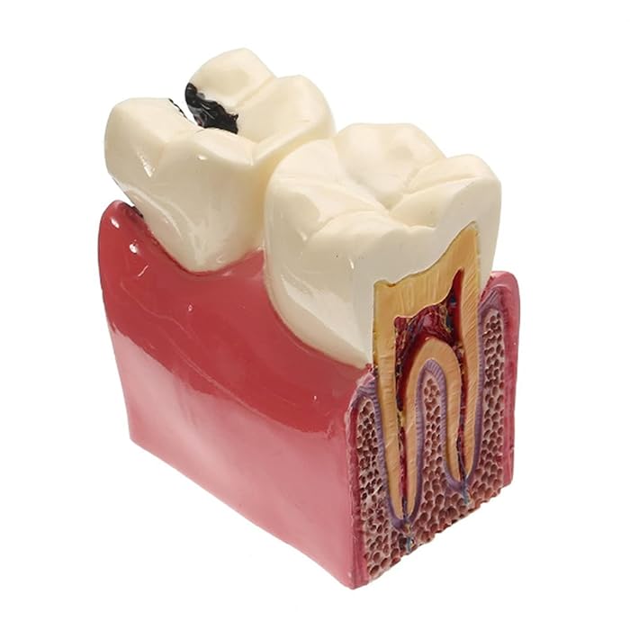 Buy Dental Caries Tooth Model, Dental Anatomy Education Tooth Model ...
