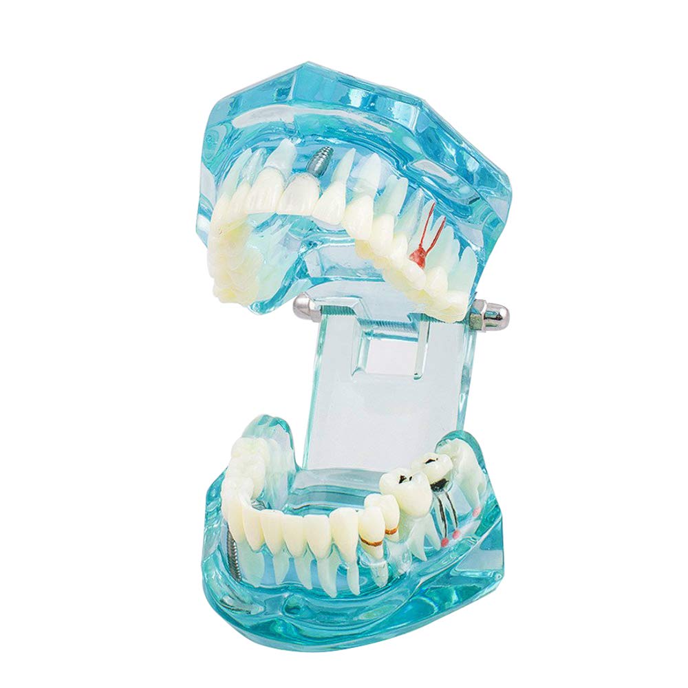 Snapklik.com : Transparent Disease Teeth Model, YOUYA DENTAL ...