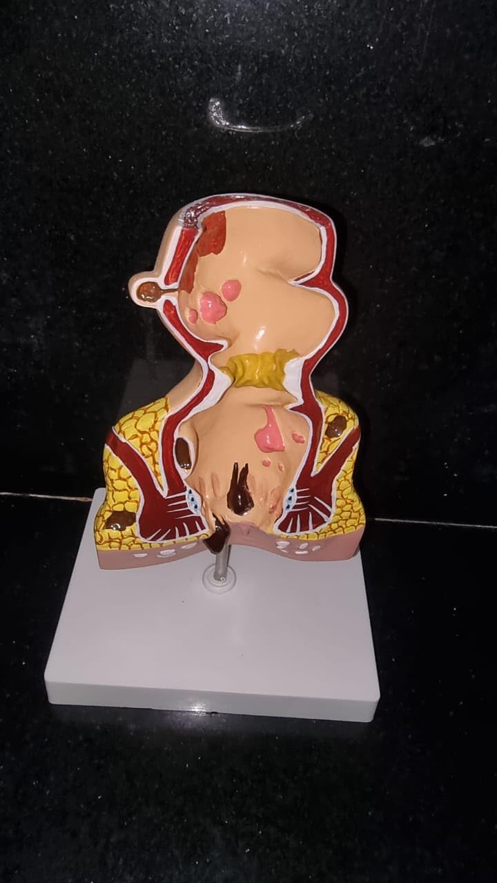 G.D. Anatomicals®"Human Body Anatomy Rectum Model with Common ...