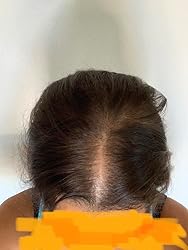 Amazon.com : NutraM™ Hair Growth Serum – Dermatologist Tested, Approved ...