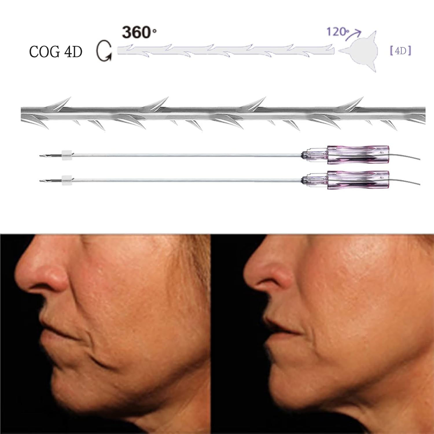 Pcl Cog Thread 4DV Face Lift, Cog Threads 360R Bi-Direction Cog 12PCS ...