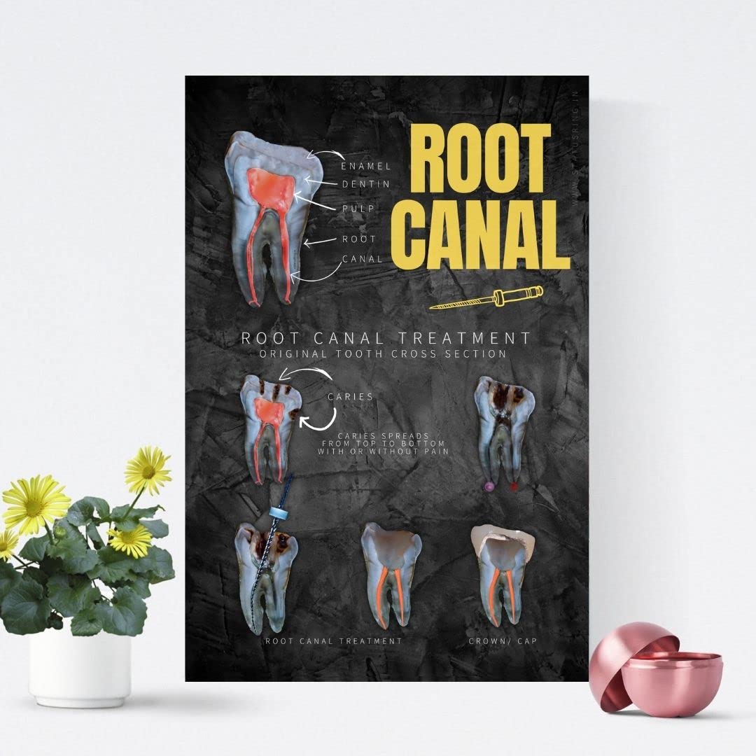 Root canal CS explained patient education Dental poster for dentist ...