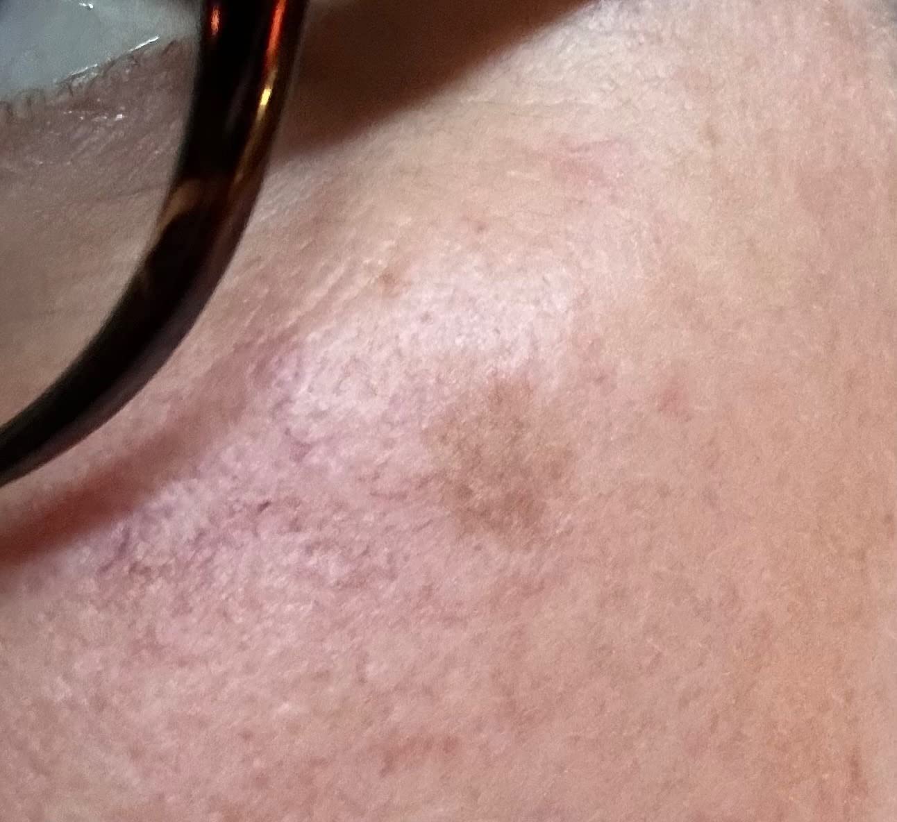 $4/mo - Finance Tranexamic Acid Serum 5% (TXA) with Kojic Acid ...