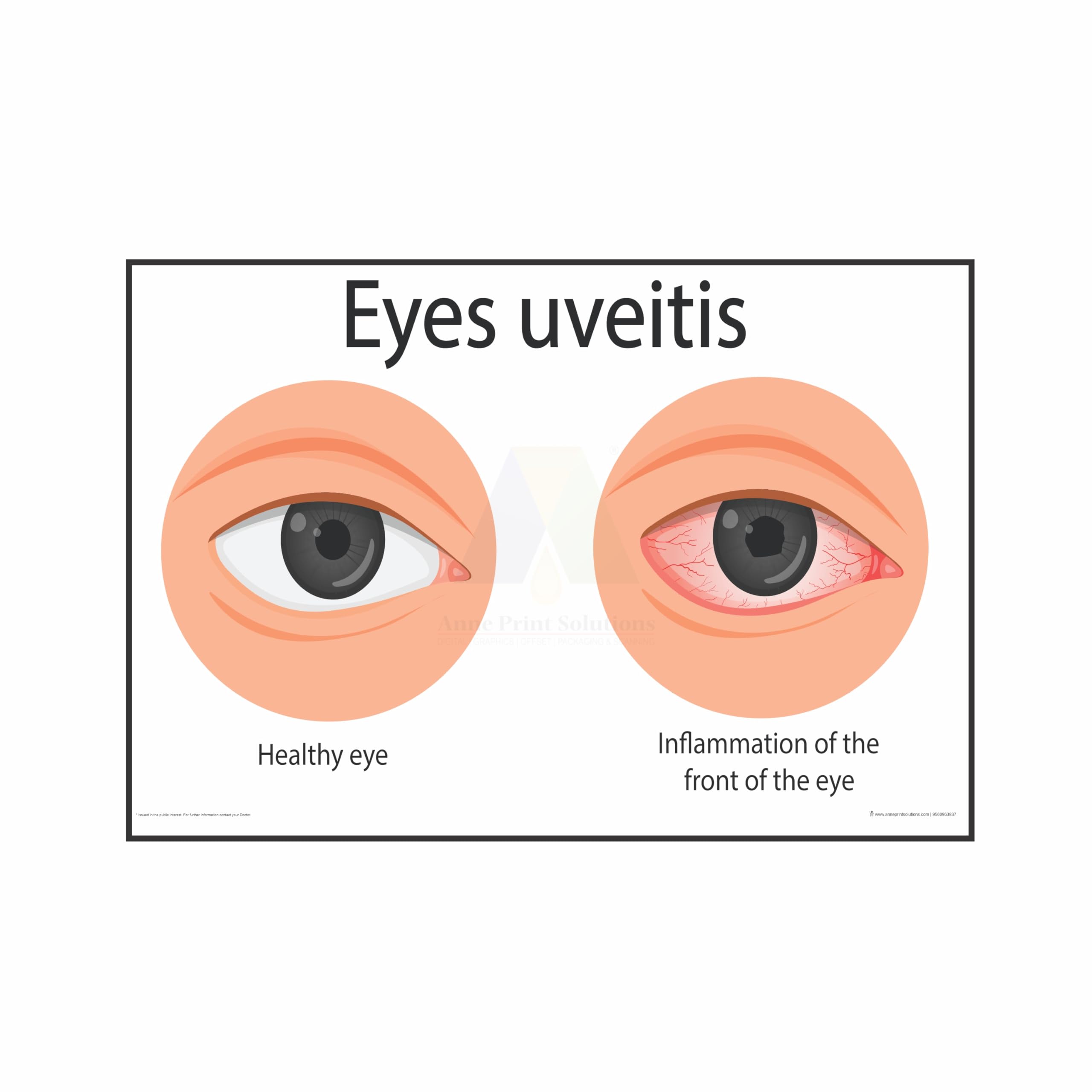 Anne Print Solutions® Eye uveitis Posters For Hospital Posters ...