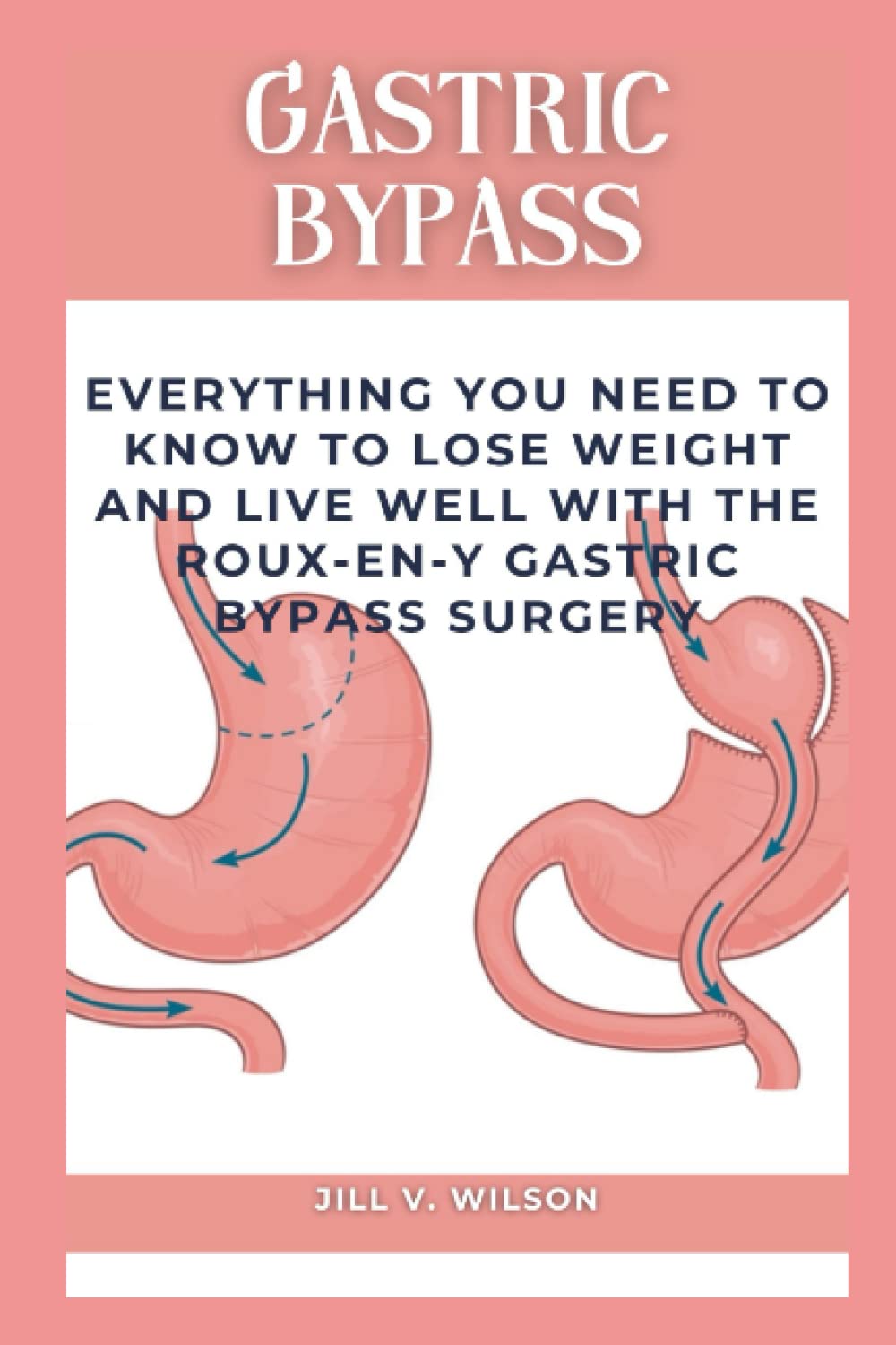 GASTRIC BYPASS: Everything You Need To Know to Lose Weight and Live ...