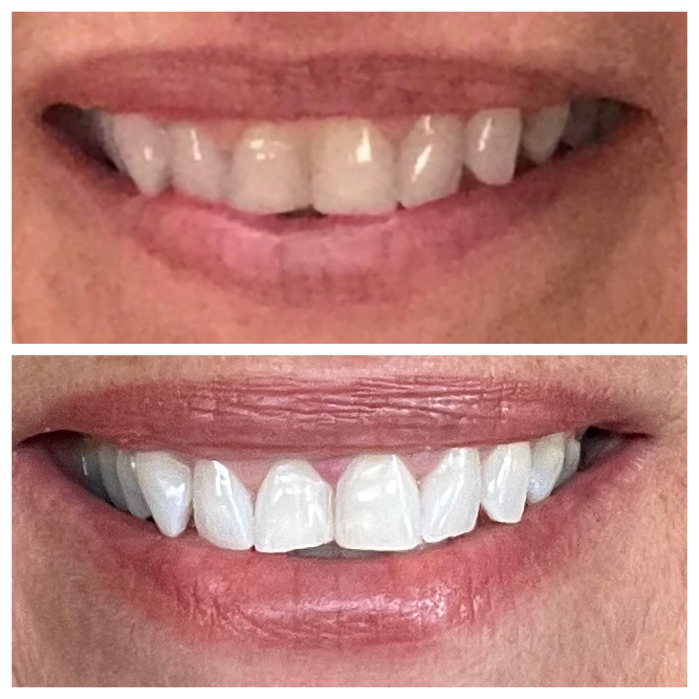 $5/mo - Finance VieBeauti Teeth Whitening Kit - 5X LED Light Tooth ...