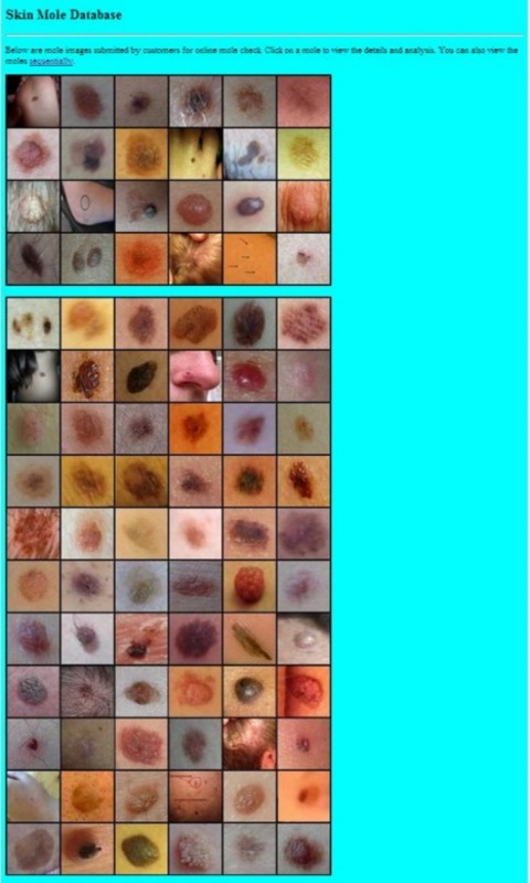 Skin Mole Analysis - App on Amazon Appstore