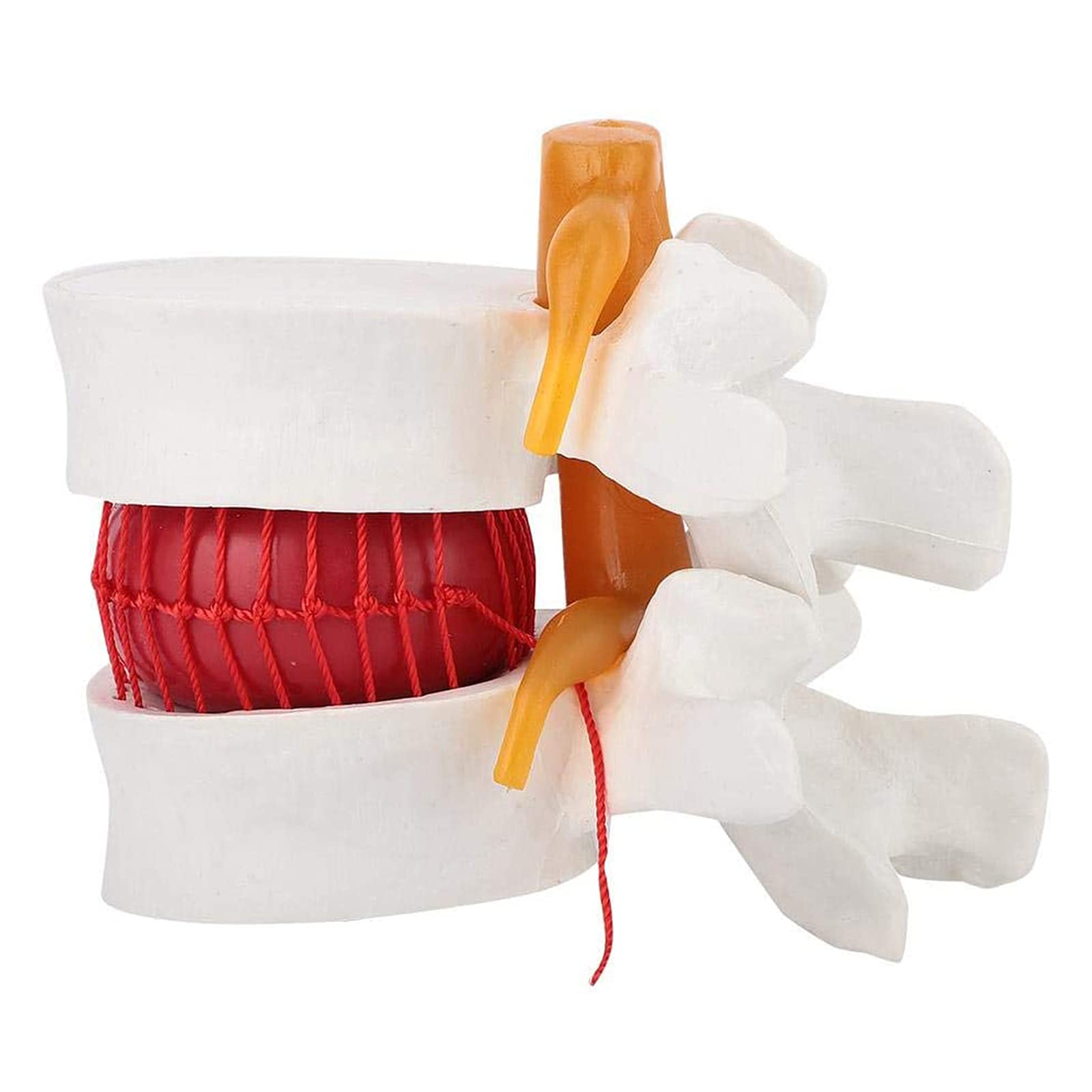 Buy Lumbar Disc Herniation Model, Human Anatomy Lumbar Disc Herniation ...