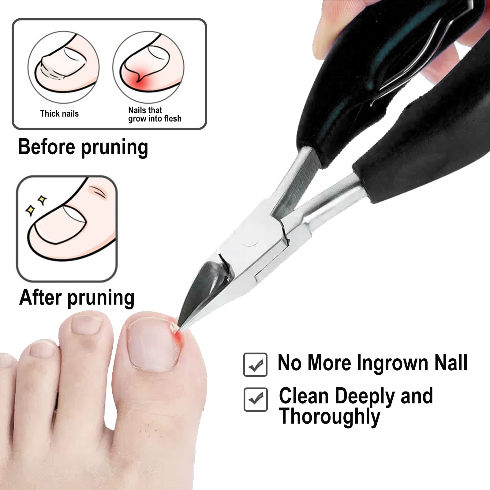 Snapklik.com : (30+3) Pack Ingrown Toenail Correction Treatment Kit ...