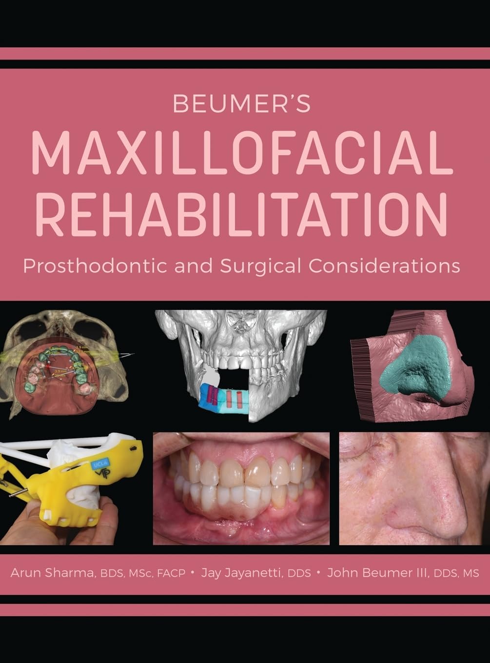Beumer's Maxillofacial Rehabilitation: Prosthodontics and Surgical ...