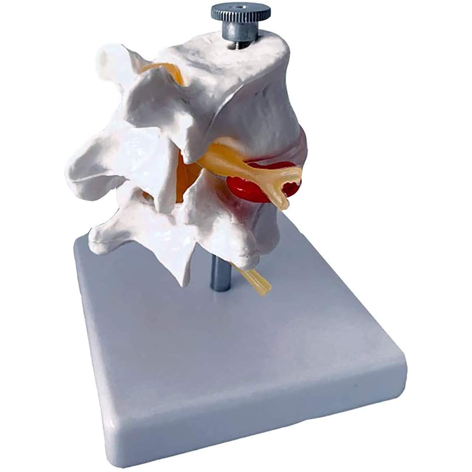 Buy Spine Lumbar Disc Herniation Model, Anatomical Lumbar Disc ...