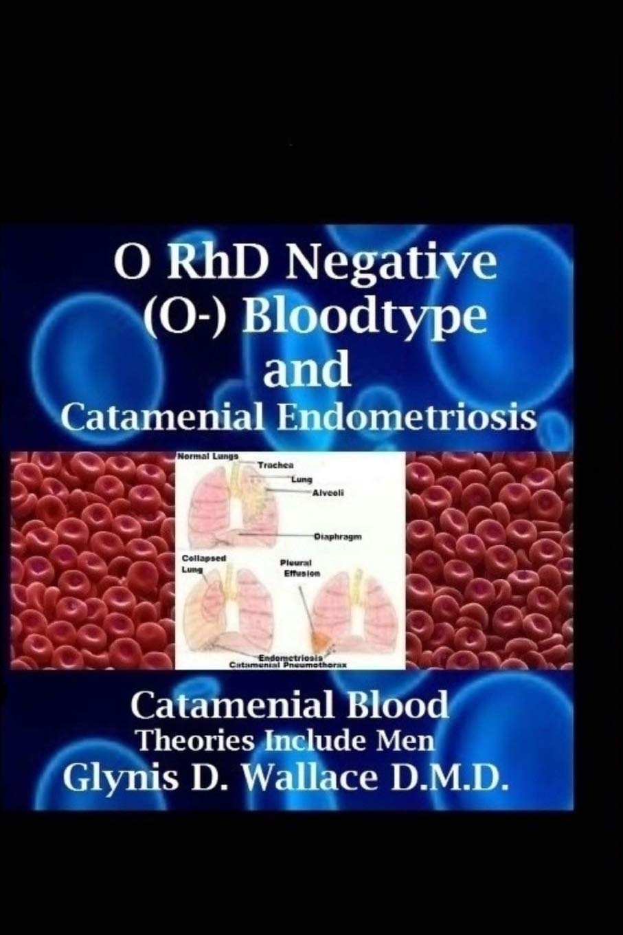 O RhD Negative (O-) Bloodtype And Catamenial Endometriosis: Catamenial ...