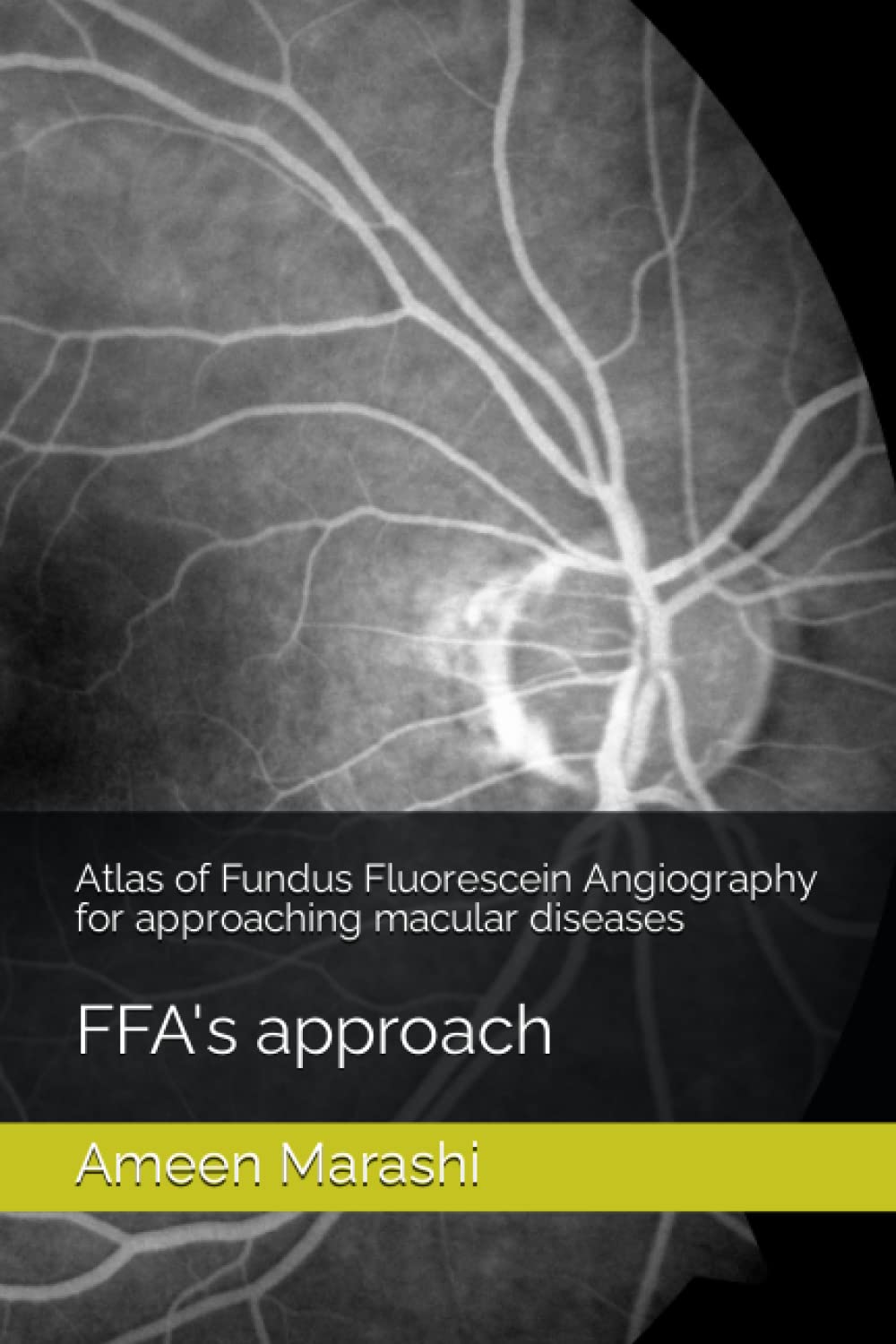 Atlas of Fundus Fluorescein Angiography for approaching macular ...