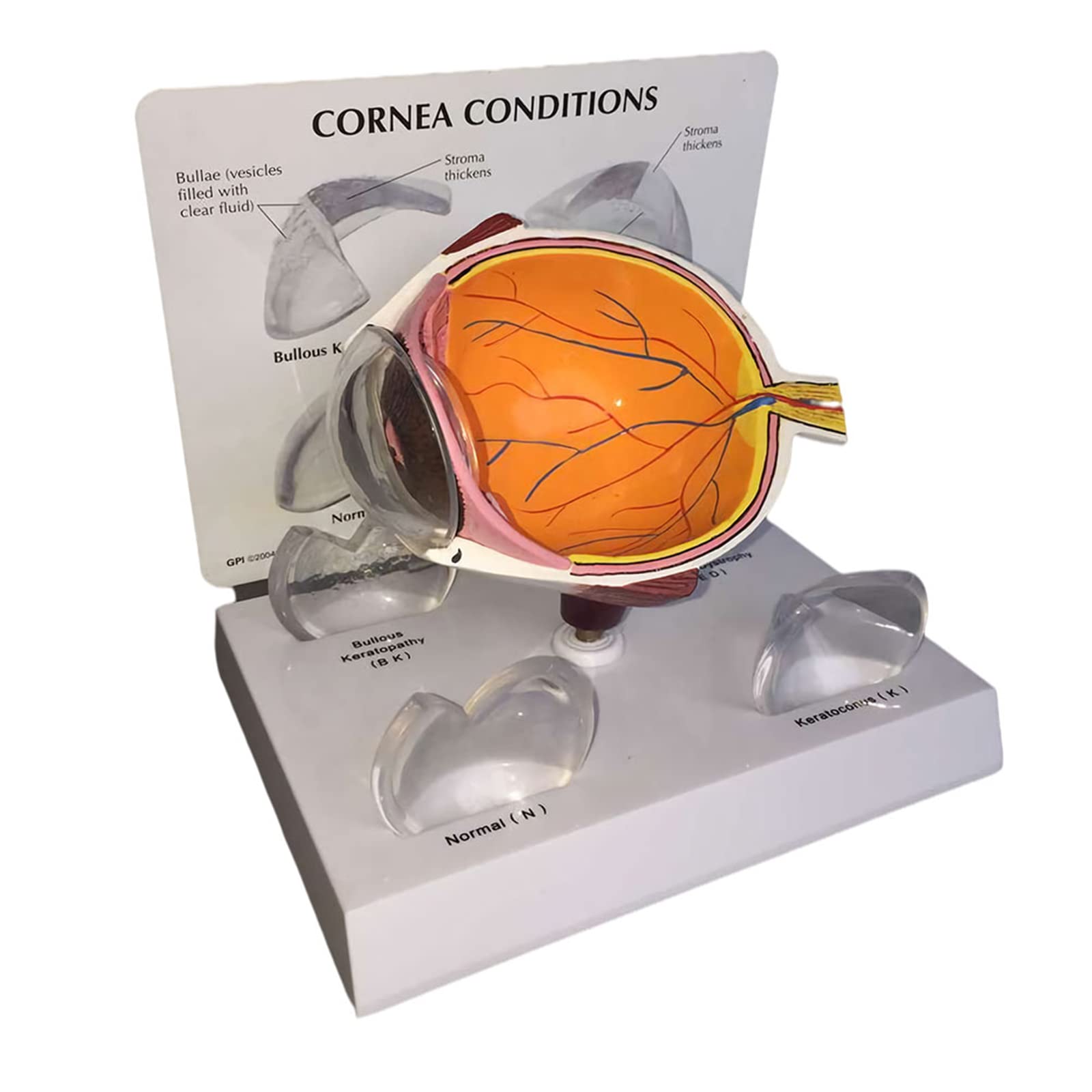 Buy 5X d Eyeball Disease Model, Cataract Eye Model, Anatomically ...