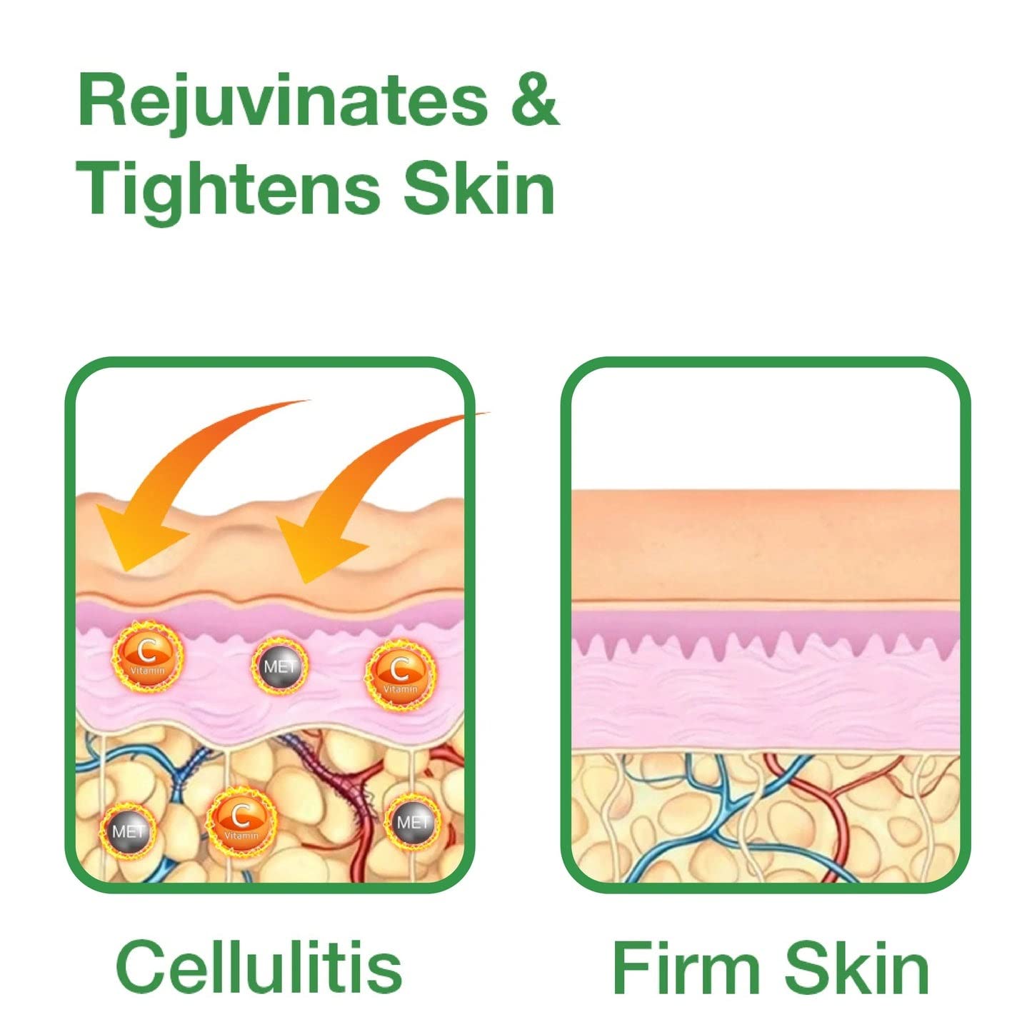 Cellulite Diagram