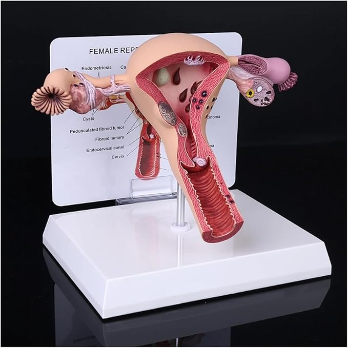 Amazon.com: SUZLAZYR Pathological Uterus Ovary Model, Female ...