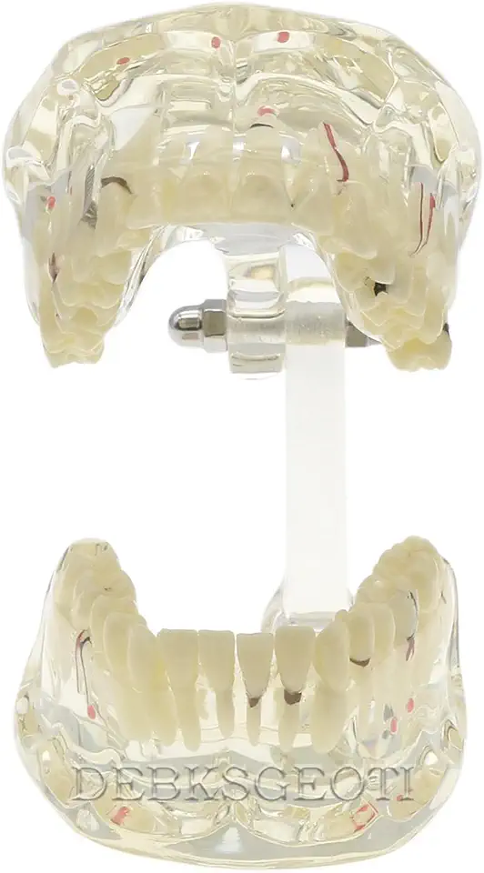 Understanding The Implications Of A Cyst Developing Around A Wisdom ...