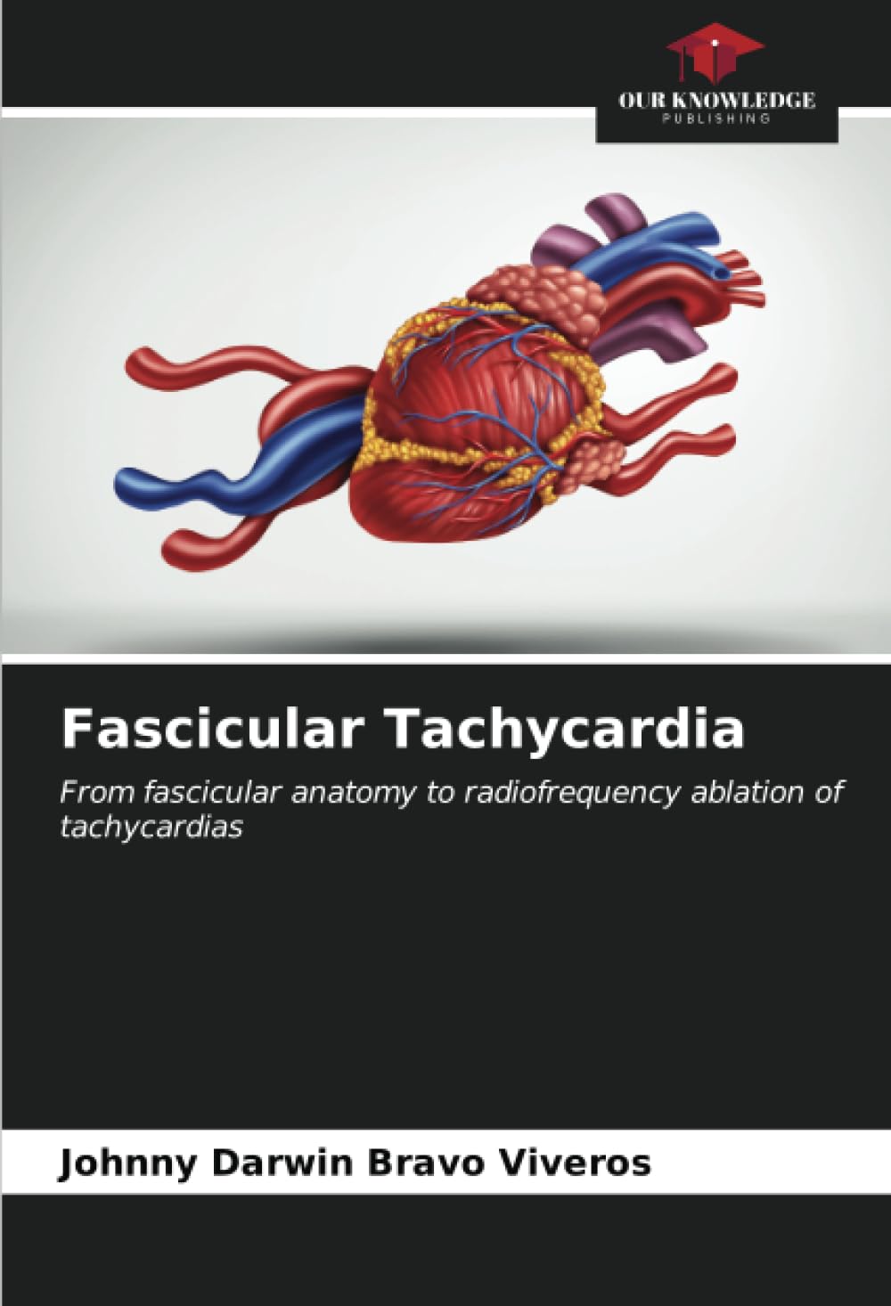 Fascicular Tachycardia: From fascicular anatomy to radiofrequency ...