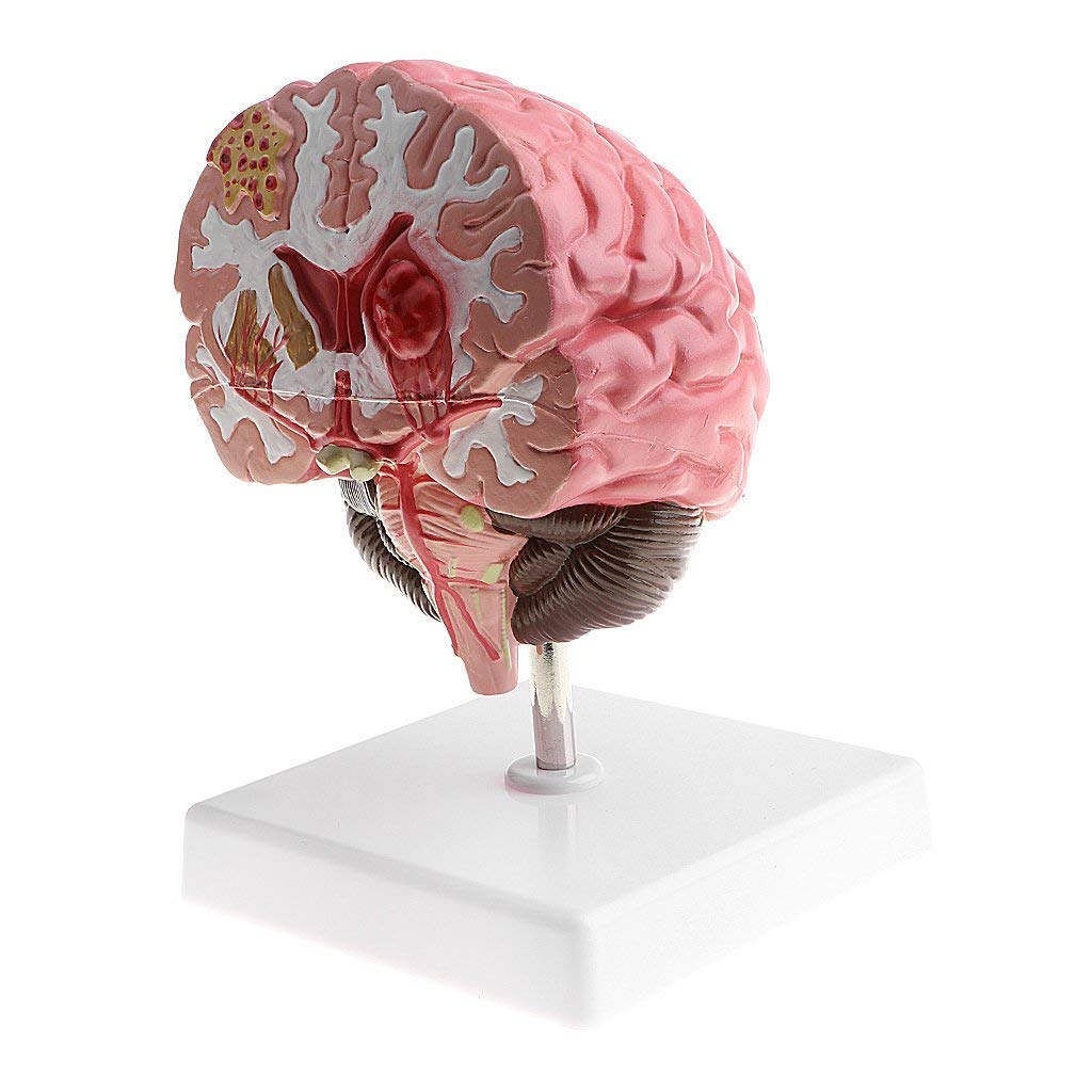 Buy Education Model Toy Human Brain Pathology Model Cerebral Hemorrhage ...