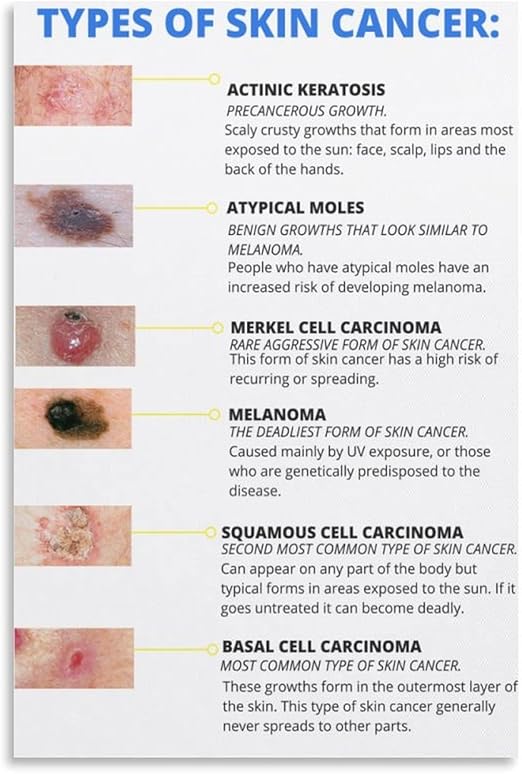 Amazon.com: AsCoRP Skin Cancer Type Poster Canvas Painting Wall Art ...