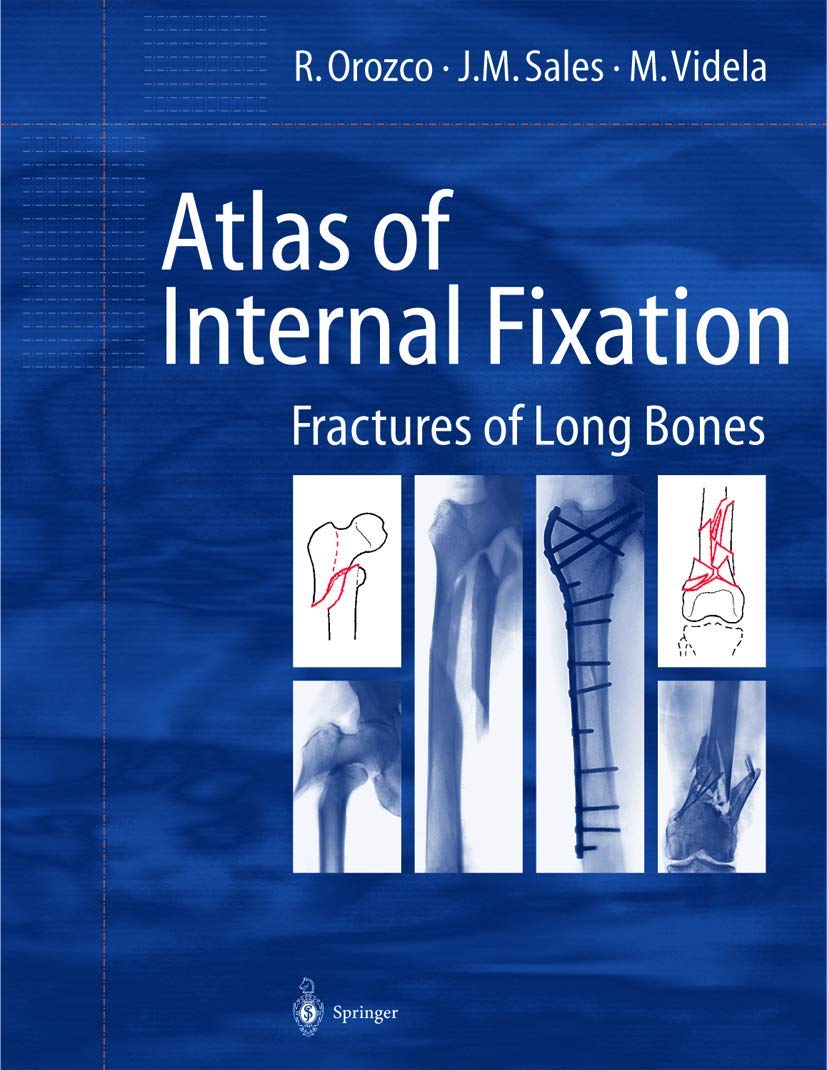 Atlas of Internal Fixation: Fractures of Long Bones: 9783540656210 ...