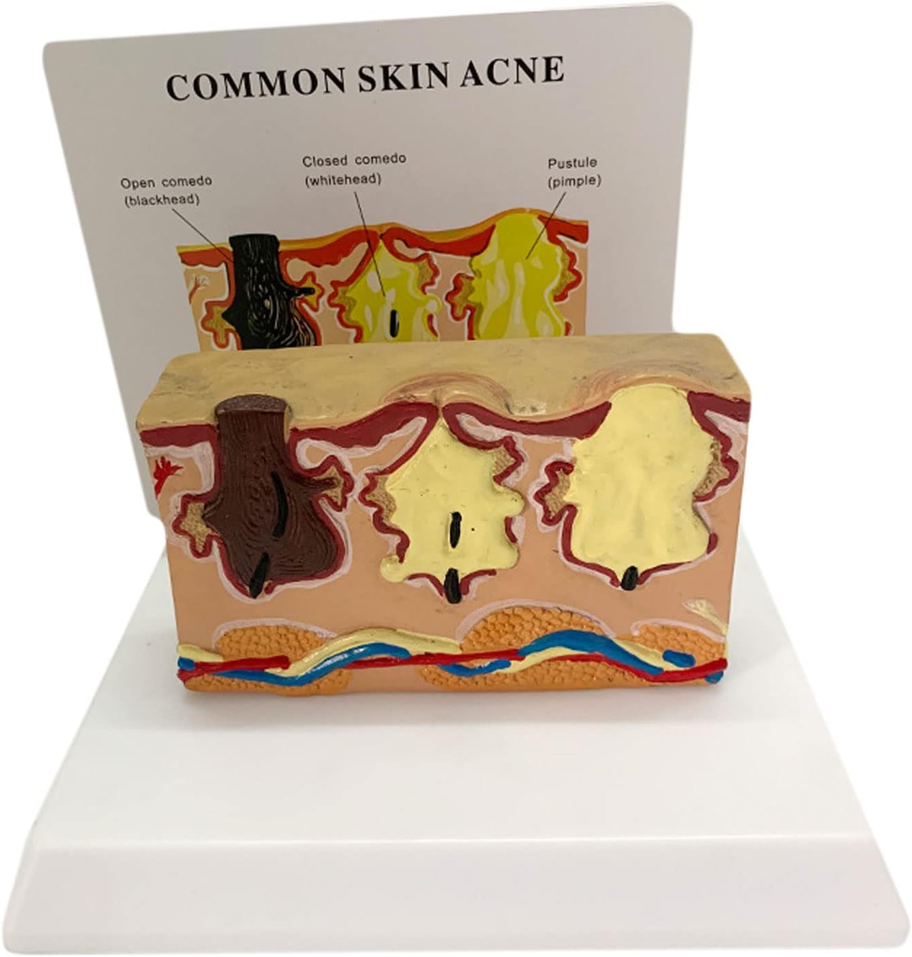 UPIKIT Human Skin Structure Model, Common Skin Acne Enlarge Structure ...