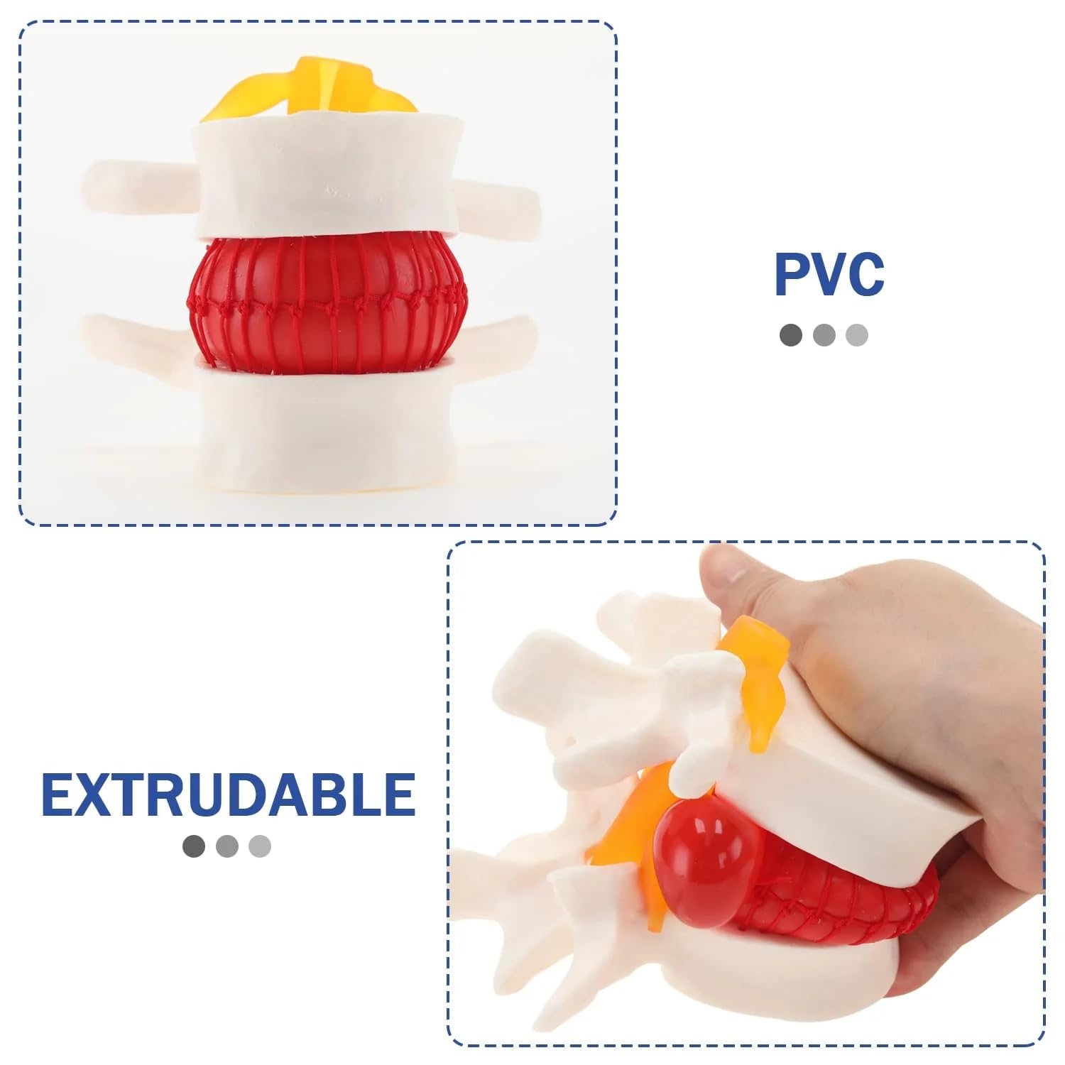 Snapklik.com : Human Anatomical Lumbar Disc Herniation Model - Lumbar ...