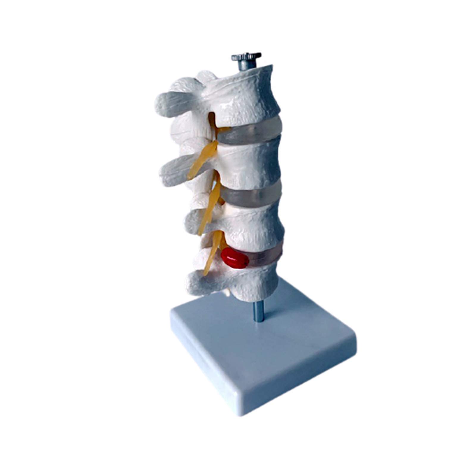 XIEZI Anatomical Model Lumbar Disc Herniation Demonstration Model ...