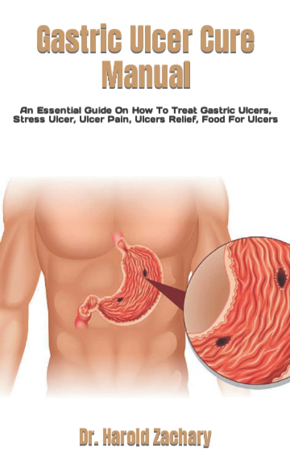 Buy tric Ulcer Cure Manual: An Essential Guide On How To Treat tric Ulcers, Stress Ulcer, Ulcer ...