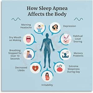 Amazon.com: Sleep Apnea Infographic Poster Hospital Wall Decor Science ...