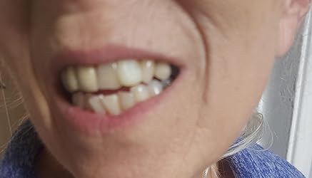 CREADENT Kit for Replacing a Missing Tooth with a Temporary Cosmetic ...