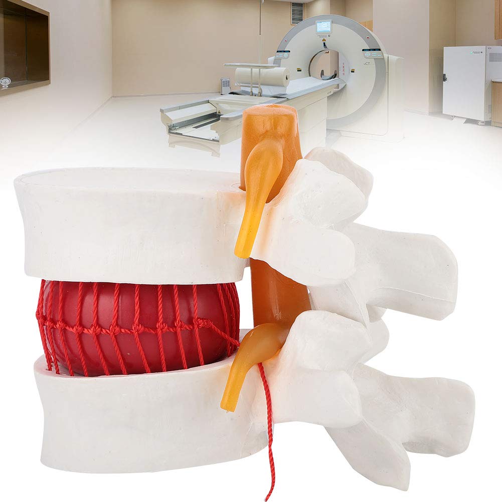 Human Anatomical Lumbar Disc Herniation Model 1:1.5 Lumbar Spine Model ...