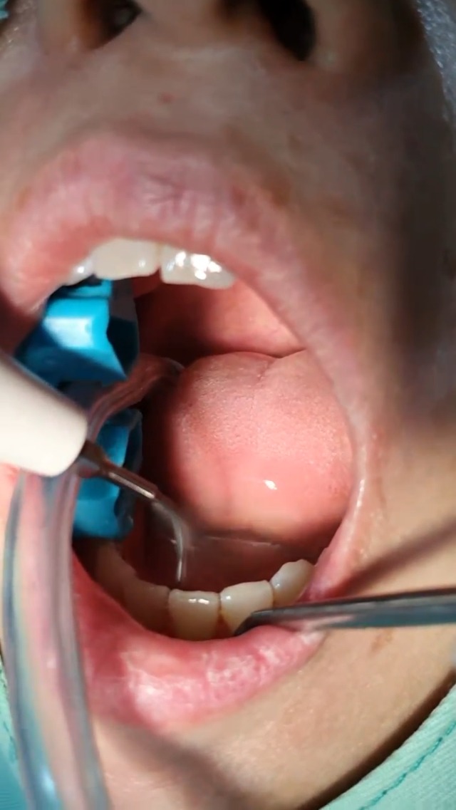 Watch EZ Bite Block Disposable Mouth Prop on Amazon Live