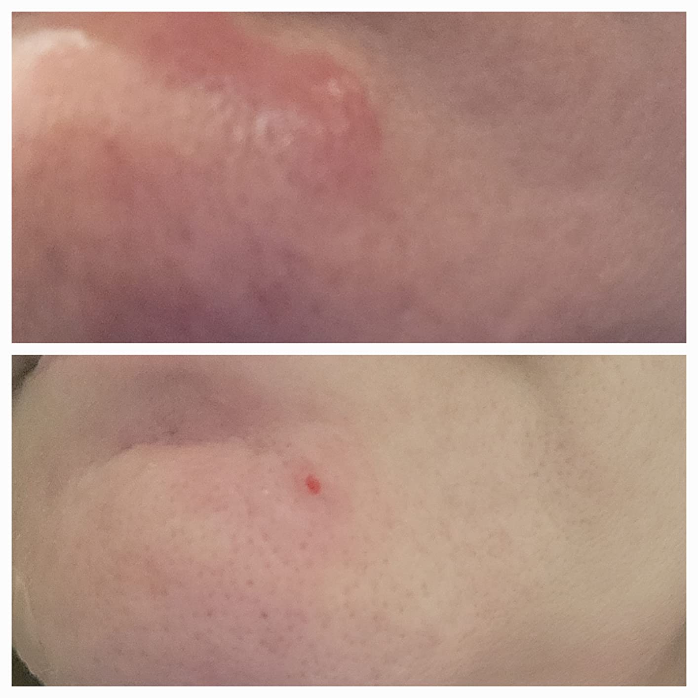 Amazon.com: Neutrogena Stubborn Acne Blemish Patches, Ultra-Thin ...