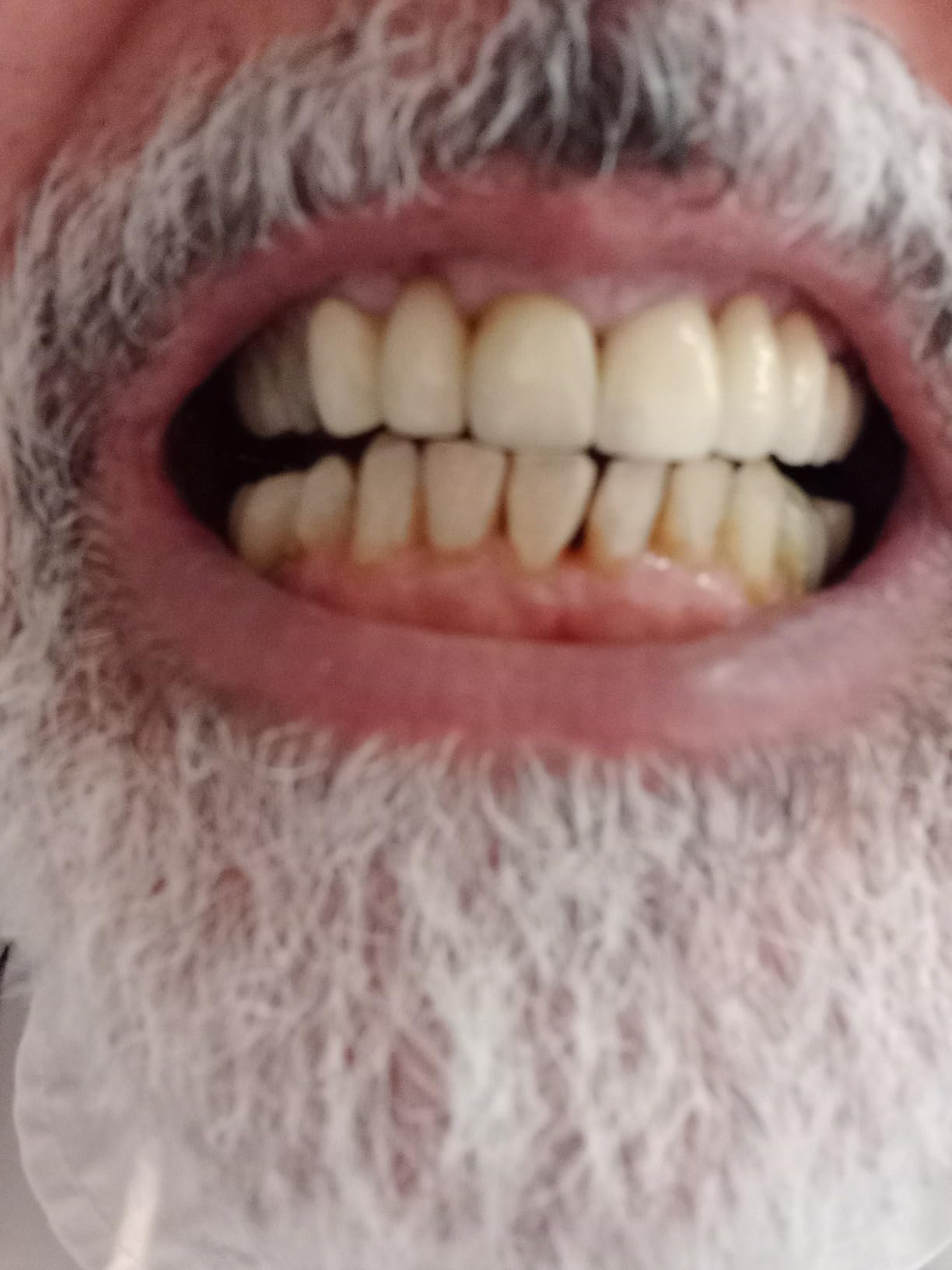 Tooth Polisher, ZoCCee Multifunctional Teeth Whitening Kit with 5 Modes ...