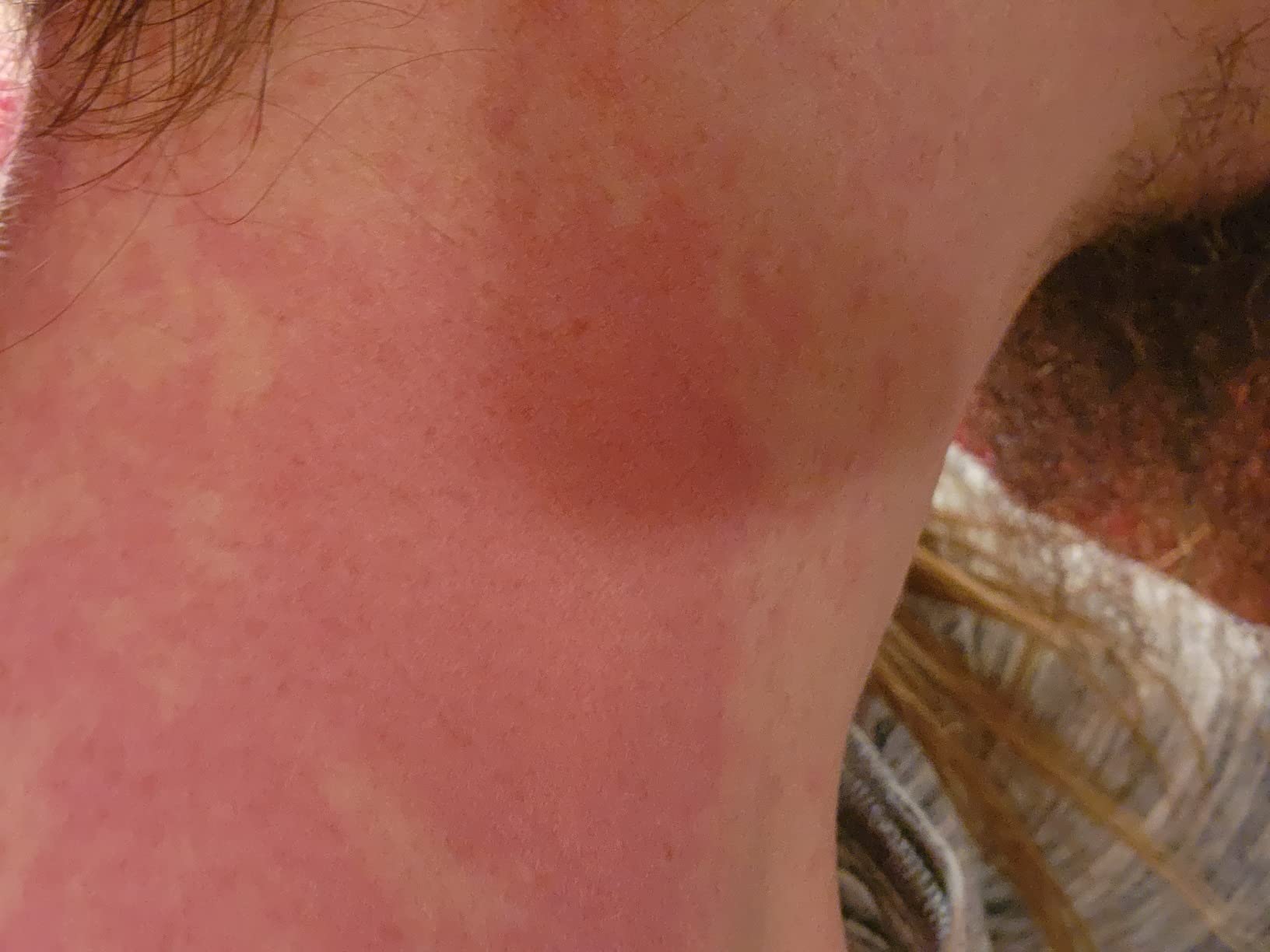 Red Blotchy Rash On Neck Eczema On The Neck: Symptoms, Treatment, And