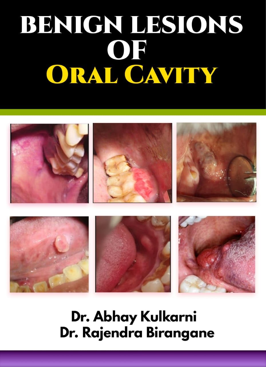 Benign Lesions of Oral Cavity: Amazon.co.uk: 9789394817821: Books