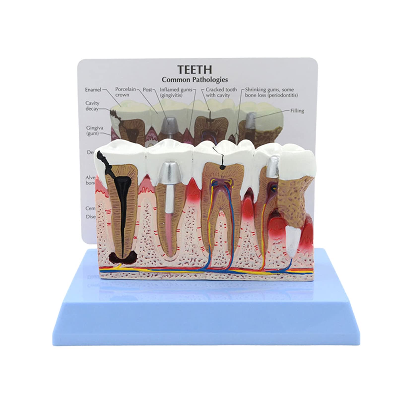 Buy Dental Teeth Common Pathologies Model, Periodontal Disease Assort ...