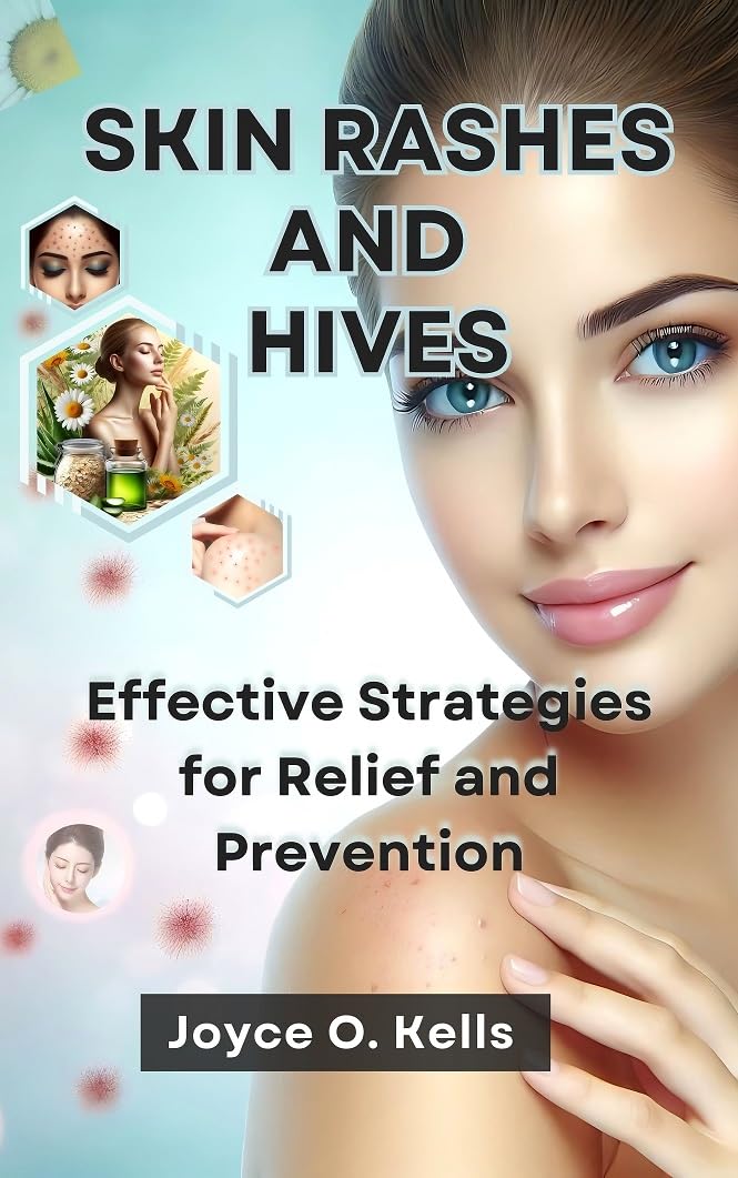 Amazon.com: Skin Rashes and Hives: Effective Strategies for Relief and ...