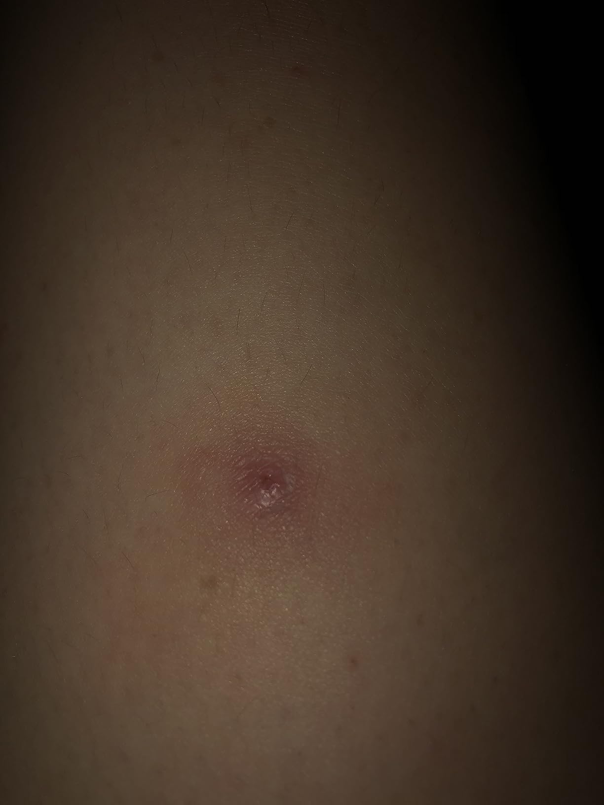 Amazon.com: BUG BITE THING Suction Tool - Bug Bites and Bee/Wasp Stings ...